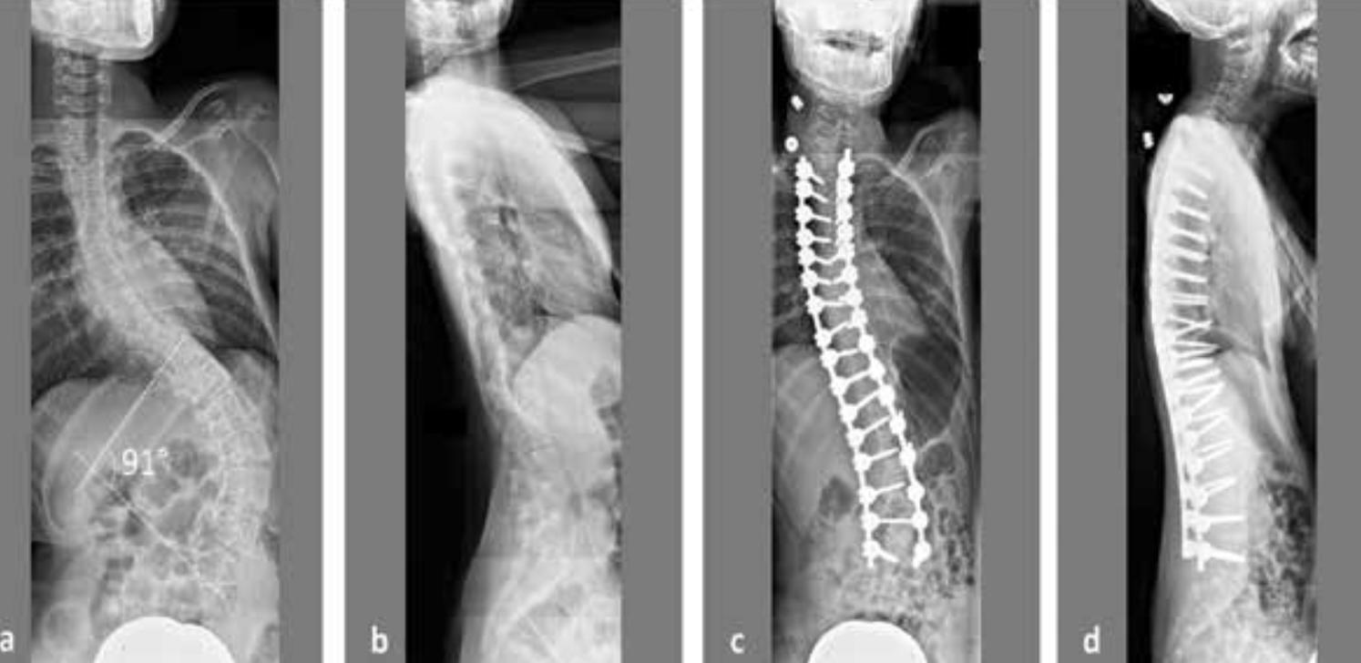 Scoliosis: Causes, symptoms, and treatment options - The Washington ...