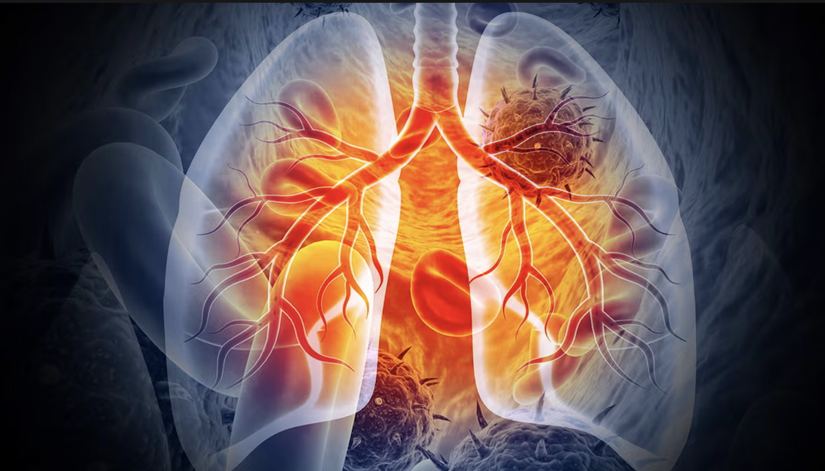 Lung cancer: A major concern for Black Americans - The Washington Informer